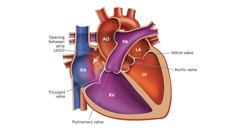 High-Quality ASD Closure (Repair) Surgery Cost In India | 98% Success Rate