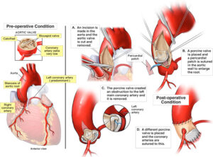 Best Bentall Surgery Cost In India 2022-Medicare Spots