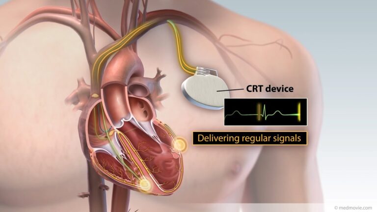 (CRT-D Implant) Cardiac Resynchronization Therapy Cost In India