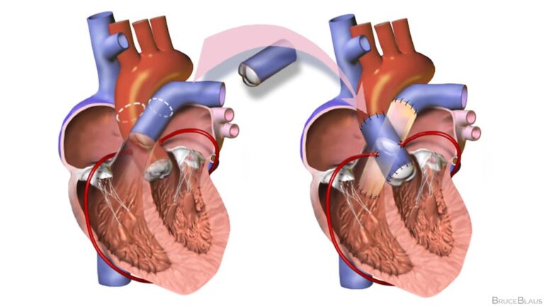[Mechanical & Tissue] Double Valve Replacement Cost In India