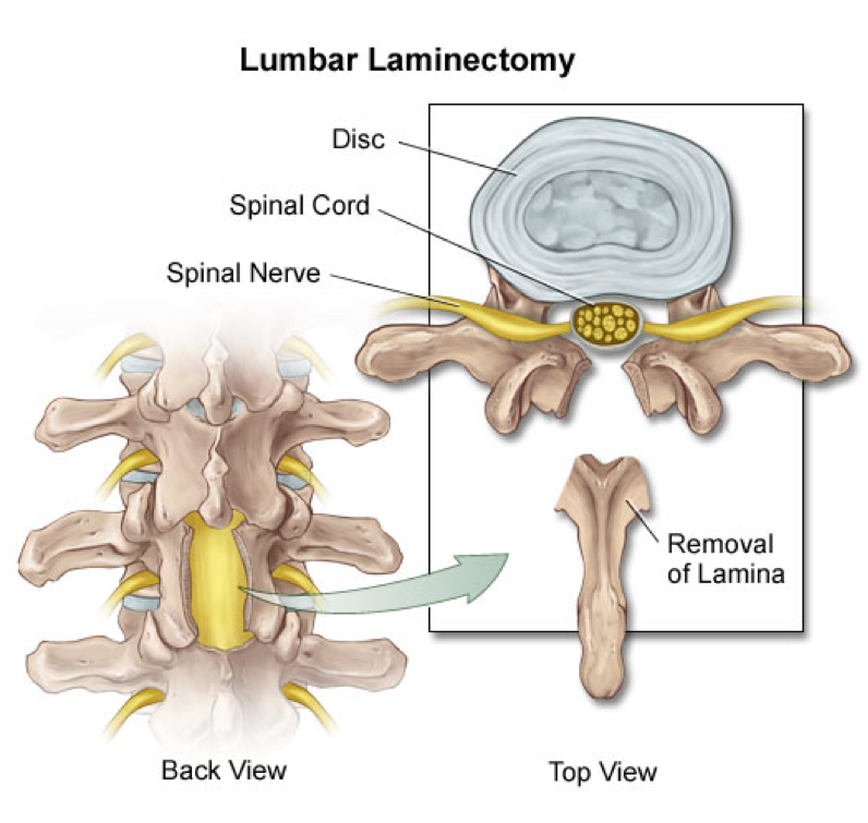 High Quality Lumbar Laminectomy Surgery Cost In India Medicare Spots High Quality Lumbar Laminectomy Surgery Cost In India Medicare Spots