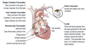 Pacemaker Implantation Cost, Types, Procedure, Success Rate, Recovery ...