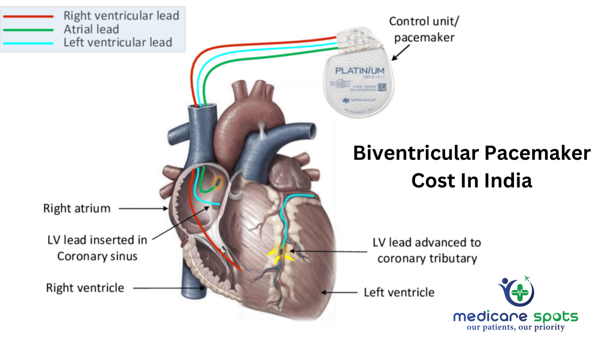 Top Quality Best Biventricular Pacemaker Cost In India Medicare Spots