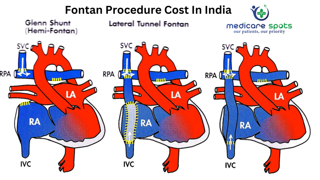 Best Fontan Procedure Cost In India | Medicare Spots