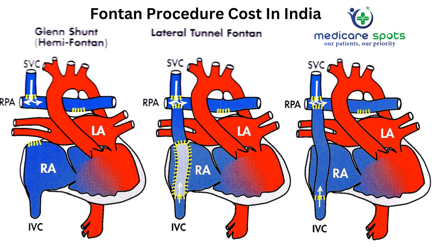 Best Fontan Procedure Cost In India | Medicare Spots